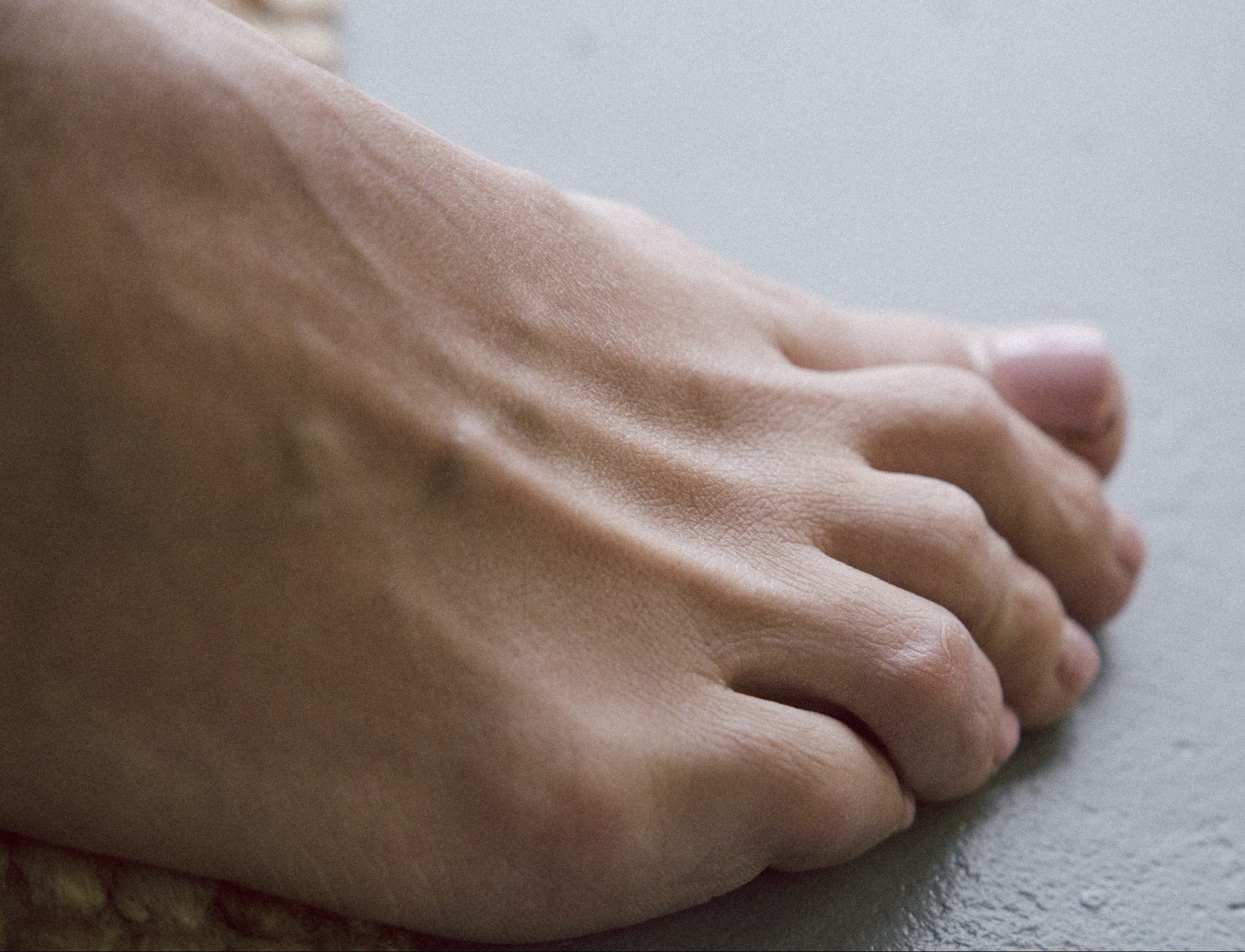 Fungal Nails - Mudgeeraba Podiatry